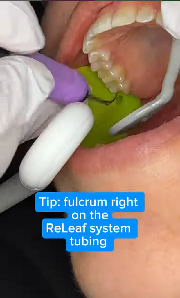 Shelley the Hygienist - Advanced Fulcrums 101 with ReLeaf